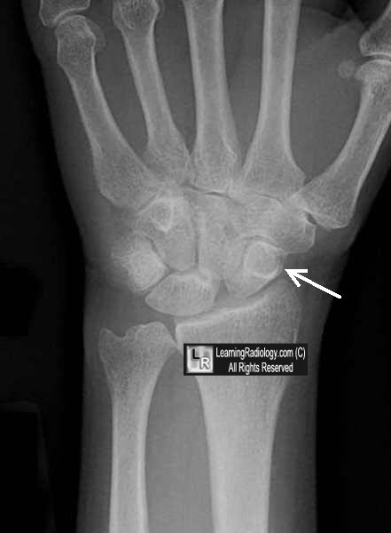 Welcome to LearningRadiology - radiology, radiologic, imaging, signs ...