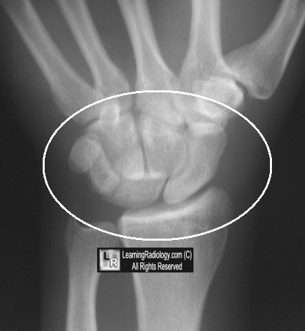 Welcome to LearningRadiology - radiology, radiologic, imaging, signs ...