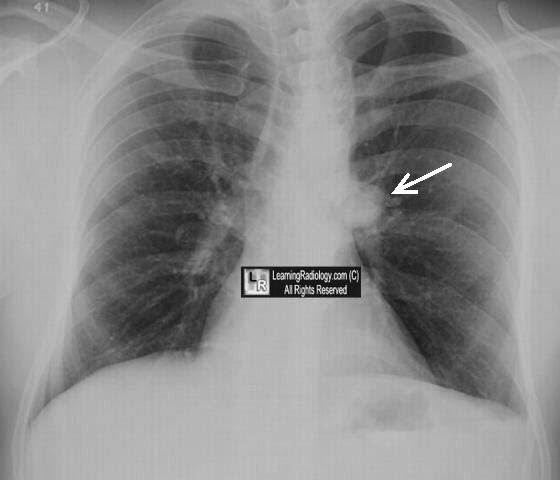 Welcome to LearningRadiology - radiology, radiologic, imaging, signs ...