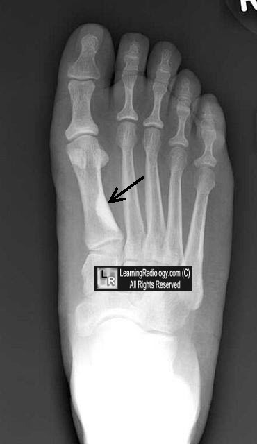 Welcome to LearningRadiology - radiology, radiologic, imaging, signs ...