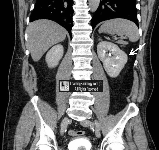 Welcome to LearningRadiology - radiology, radiologic, imaging, signs ...