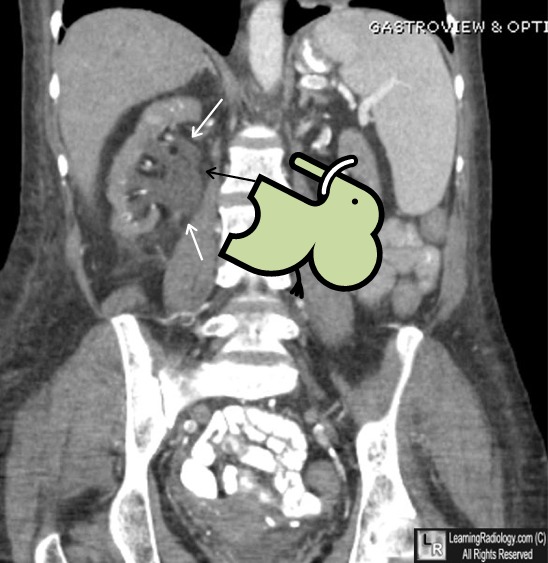 Welcome to LearningRadiology - radiology, radiologic, imaging, signs ...