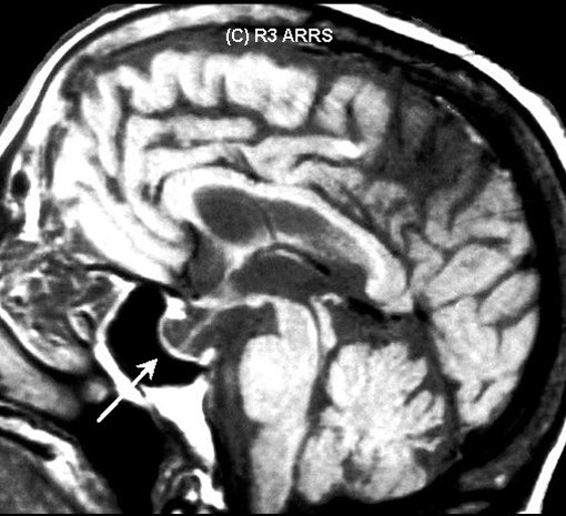 Welcome to LearningRadiology - radiology, radiologic, imaging, signs ...