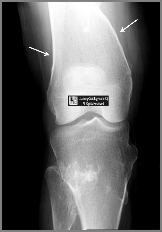 What Is Erlenmeyer Flask Bone Deformity at Shelia Meyer blog