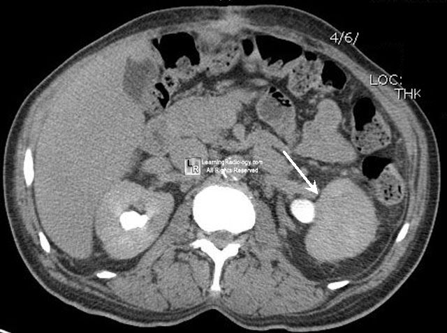 Welcome to LearningRadiology - radiology, radiologic, imaging, sign ...