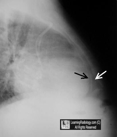 Welcome to LearningRadiology - radiology, radiologic, imaging, sign ...