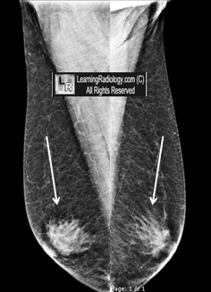 Welcome to LearningRadiology - radiology, radiologic, imaging, sign ...
