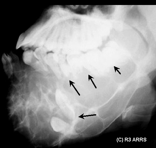 Welcome to LearningRadiology - radiology, radiologic, imaging, sign ...