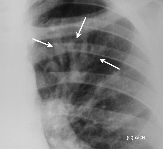 Welcome to LearningRadiology - radiology, radiologic, imaging, sign ...