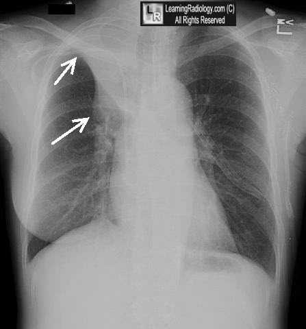 Welcome to LearningRadiology - radiology, radiologic, imaging, sign ...