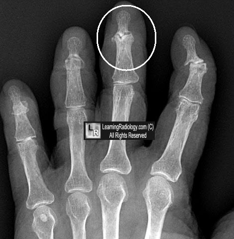 Welcome to LearningRadiology - radiology, radiologic, imaging, sign ...