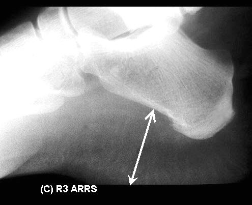 Welcome to LearningRadiology - radiology, radiologic, imaging, sign ...