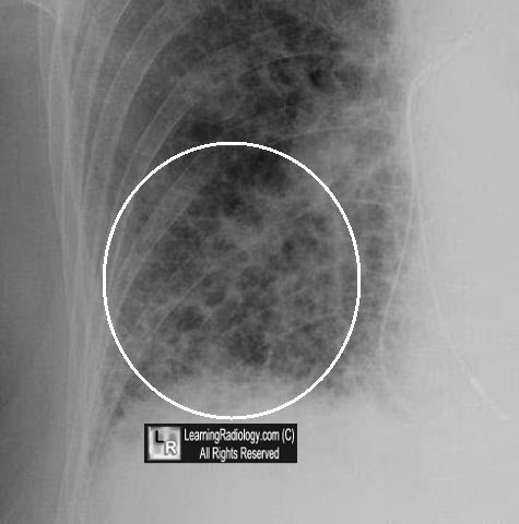 Welcome to LearningRadiology - radiology, radiologic, imaging, sign ...