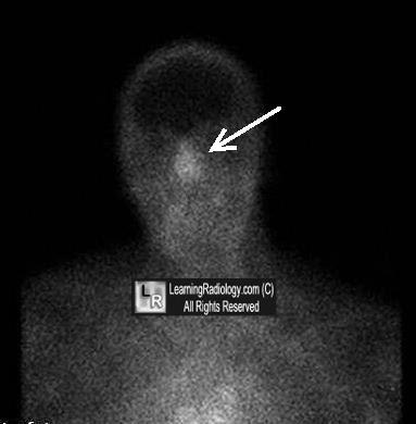 Welcome to LearningRadiology - radiology, radiologic, imaging, sign ...