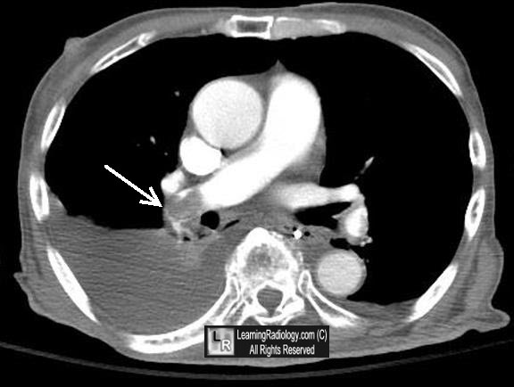 Welcome to LearningRadiology - radiology, radiologic, imaging, sign ...