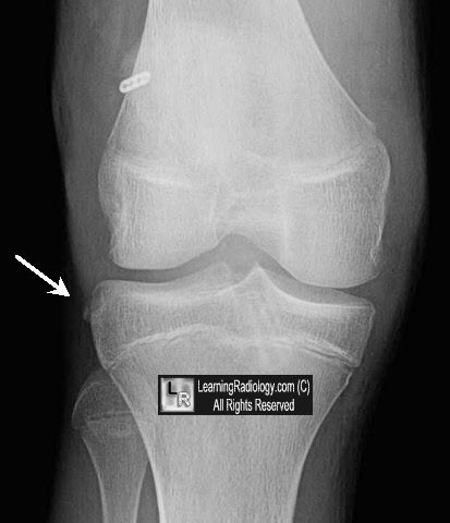 Welcome to LearningRadiology - radiology, radiologic, imaging, sign ...
