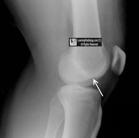 Welcome to LearningRadiology - radiology, radiologic, imaging, sign ...