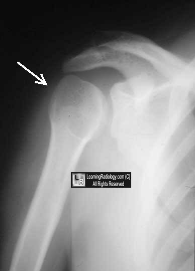 Welcome to LearningRadiology - radiology, radiologic, imaging, sign ...