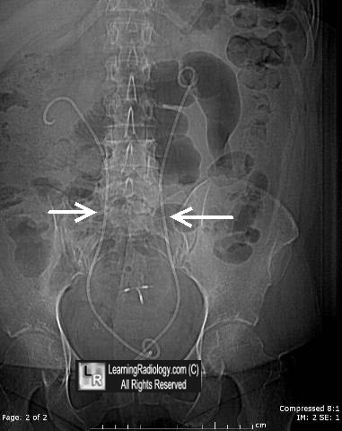 Welcome to LearningRadiology - radiology, radiologic, imaging, sign ...