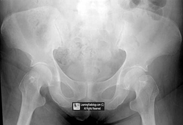 Welcome to LearningRadiology - radiology, radiologic, imaging, sign ...