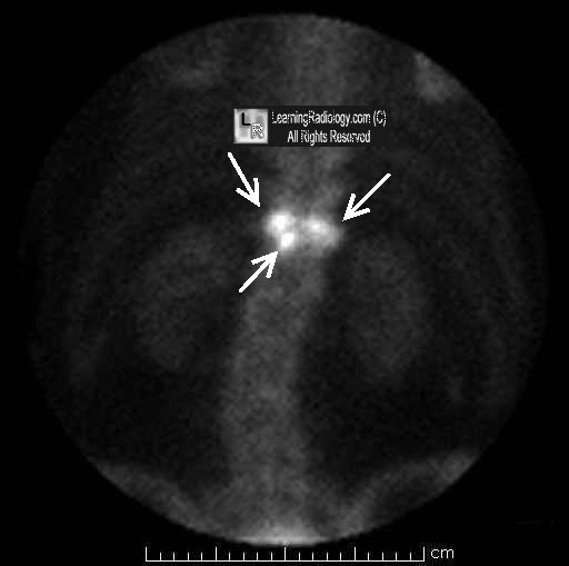 Welcome to LearningRadiology - radiology, radiologic, imaging, sign ...