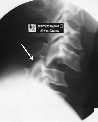 Welcome to LearningRadiology - radiology, radiologic, imaging, sign ...