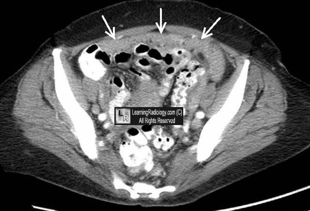 Welcome to LearningRadiology - radiology, radiologic, imaging, sign ...