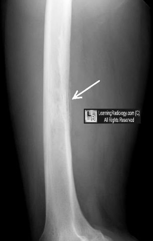 Welcome to LearningRadiology - radiology, radiologic, imaging, sign ...