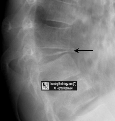 Welcome to LearningRadiology - radiology, radiologic, imaging, sign ...