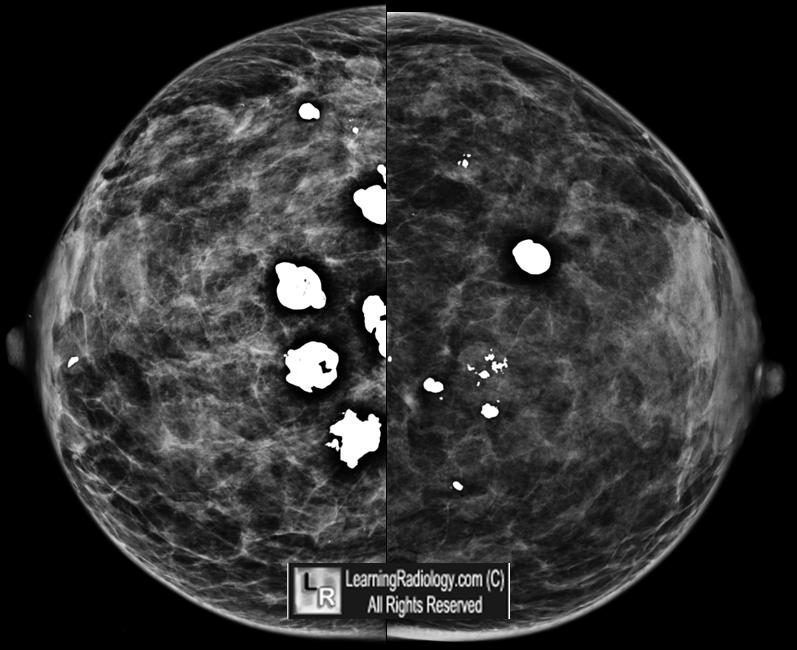 Welcome to LearningRadiology - radiology, radiologic, imaging, sign ...
