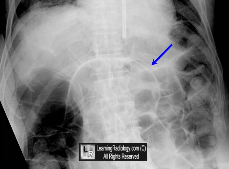 Welcome to LearningRadiology - radiology, radiologic, imaging, sign ...