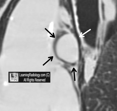 Welcome to LearningRadiology - radiology, radiologic, imaging, sign ...