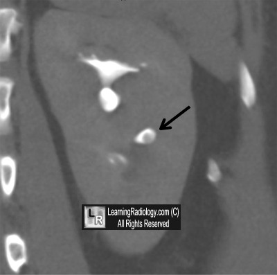 Welcome to LearningRadiology - radiology, radiologic, imaging, sign ...