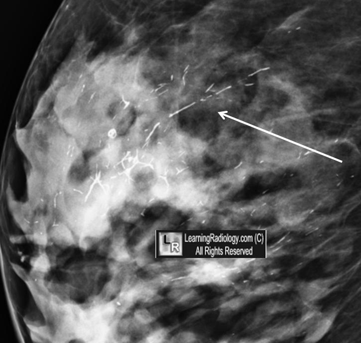 Welcome to LearningRadiology - radiology, radiologic, imaging, sign ...