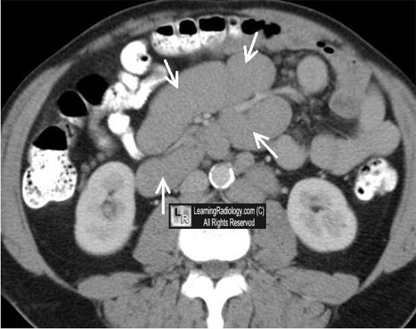 Welcome to LearningRadiology - radiology signs, imaging, radiologic ...
