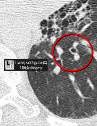 Welcome to LearningRadiology - radiology signs, imaging, radiologic ...