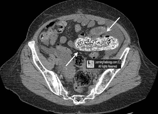 Welcome to LearningRadiology - radiology signs, imaging, radiologic ...