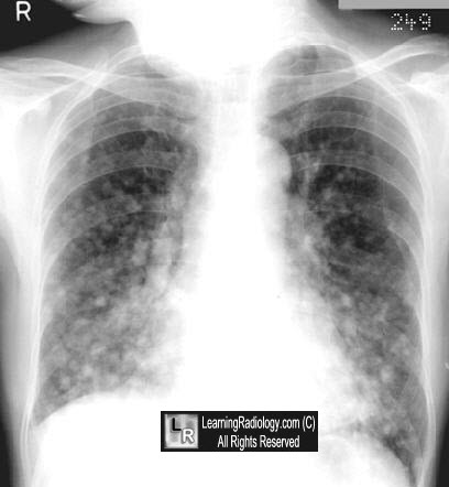 Welcome to LearningRadiology - radiology signs, imaging, radiologic ...