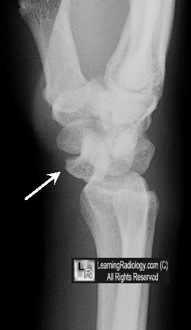 Welcome to LearningRadiology - radiology signs, imaging, radiologic ...