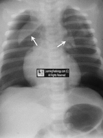 Welcome to LearningRadiology - radiology signs, imaging, radiologic ...