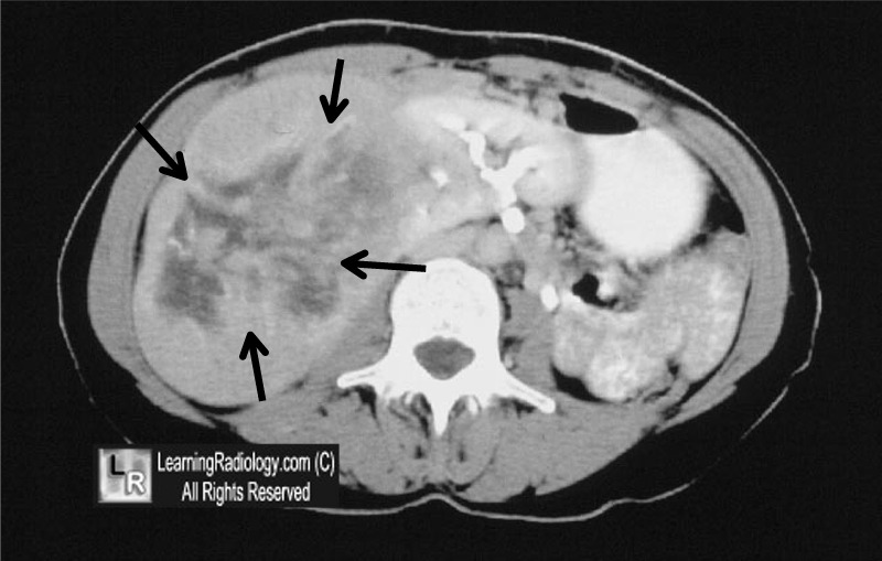 Welcome to LearningRadiology - radiology signs, imaging, radiologic ...