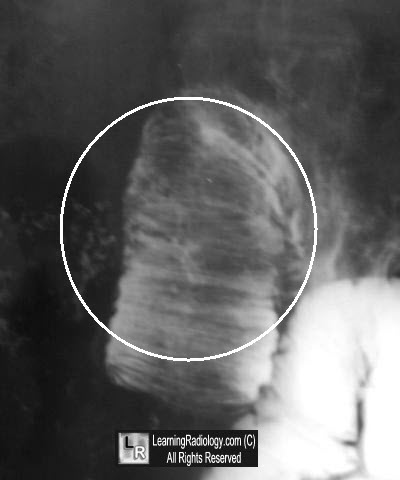 Welcome to LearningRadiology - radiology signs, imaging, radiologic ...