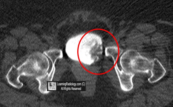 Welcome to LearningRadiology - radiology signs, imaging, radiologic ...