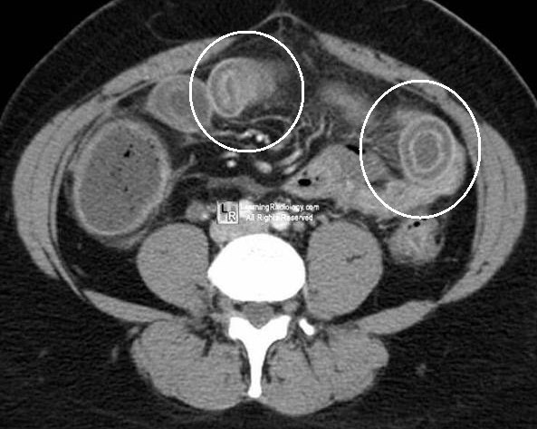 Welcome to LearningRadiology - radiology, radiologic, imaging, sign ...