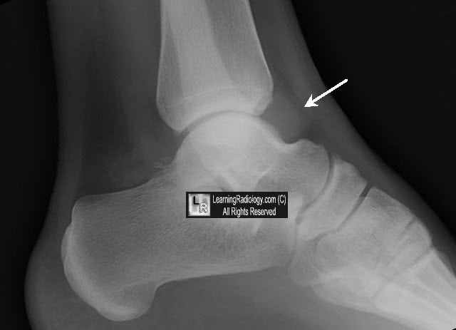 Welcome to LearningRadiology - radiology, radiologic, imaging, sign ...