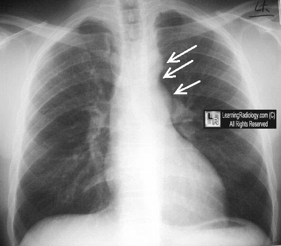 Welcome to LearningRadiology - radiology, radiologic, imaging, sign ...