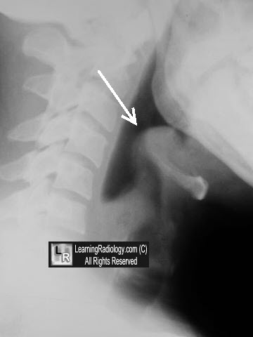 Welcome to LearningRadiology - radiology, radiologic, imaging, sign ...