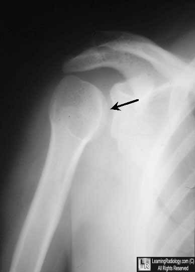 Welcome to LearningRadiology - radiology, radiologic, imaging, sign ...