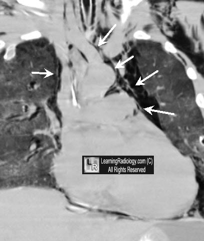 Welcome to LearningRadiology - radiology, radiologic, imaging, sign ...