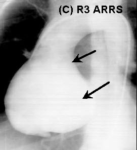 Welcome to LearningRadiology - radiology, radiologic, imaging, sign ...